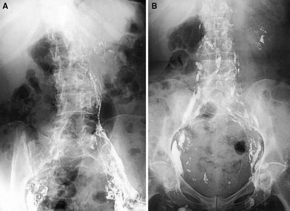 Lymphangiography in the Diagnosis and Localization of Various Chyle ...