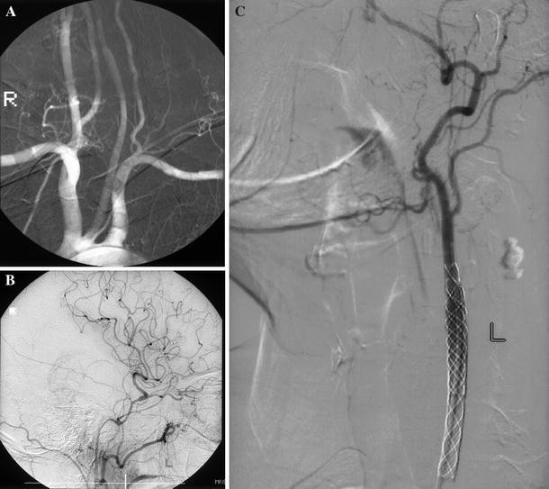 Carotid Stump Syndrome: Pathophysiology and Endovascular Treatment ...