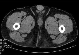 Computed Tomography–Guided Drainage of a Corpus Cavernosum Abscess: A ...