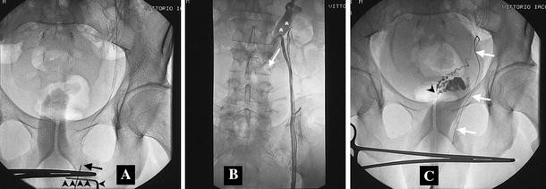 Interventional Radiology of Male Varicocele: Current Status | SpringerLink