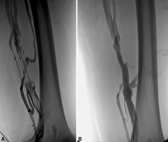 Catheter-directed Thrombolysis with Argatroban and tPA for Massive ...