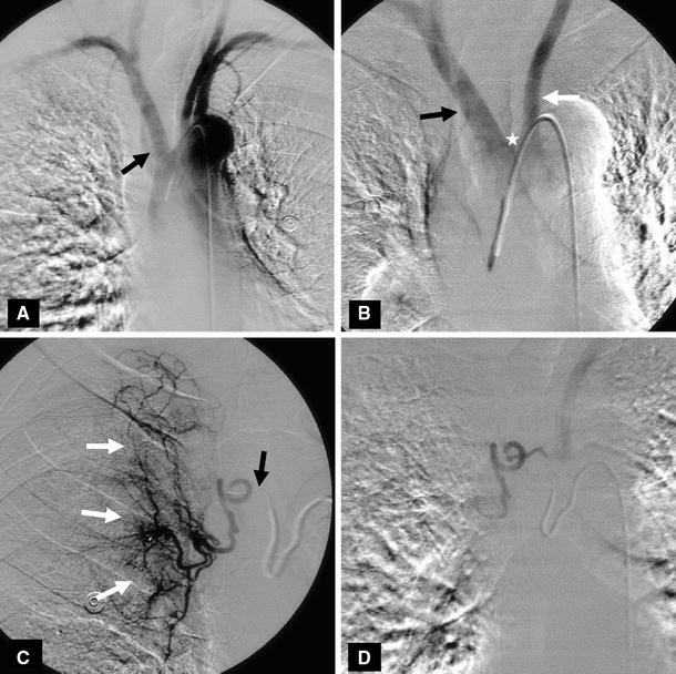 Endovascular Embolization of Bronchial Artery Originating from the ...