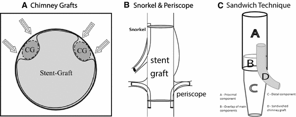 Endovascular Aortic Aneurysm Repair with Chimney and Snorkel Grafts ...