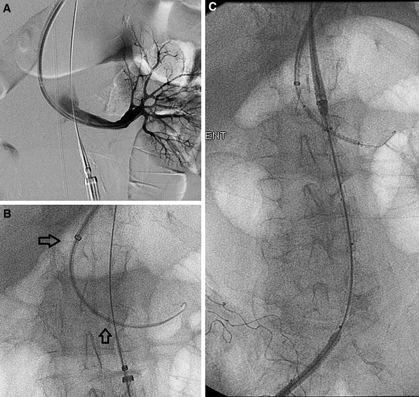 Endovascular Aortic Aneurysm Repair with Chimney and Snorkel Grafts ...