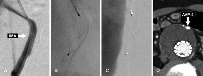 Inferior Mesenteric Artery Embolization Before Endovascular Aortic ...