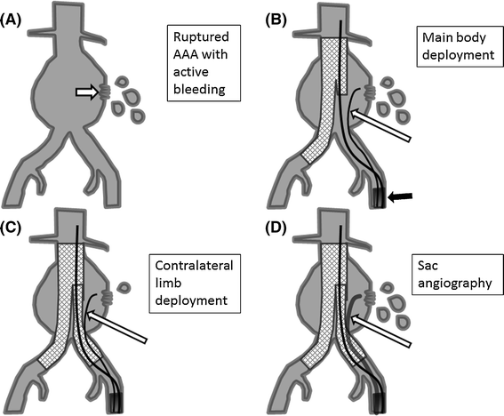 Sac Angiography And Glue Embolization In Emergency Endovascular