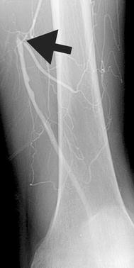 Use of Spider Filter Embolic Protection Device During Endovascular ...