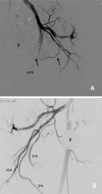 Pelvic Arterial Anatomy Relevant to Prostatic Artery Embolisation and ...
