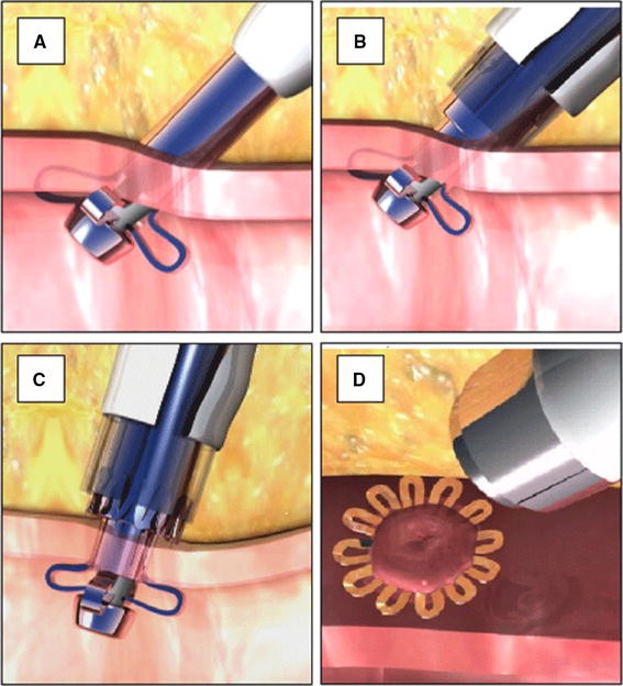 Vascular Closure Devices in Interventional Radiology Practice ...