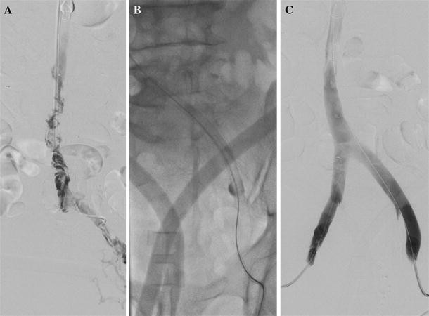 Single Center Experience with the AngioVac Aspiration System | SpringerLink
