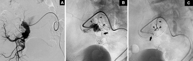 Amplatzer Vascular Plug Anchoring Technique to Stabilize the Delivery ...