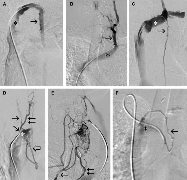 The Essentials of Parathyroid Hormone Venous Sampling | SpringerLink