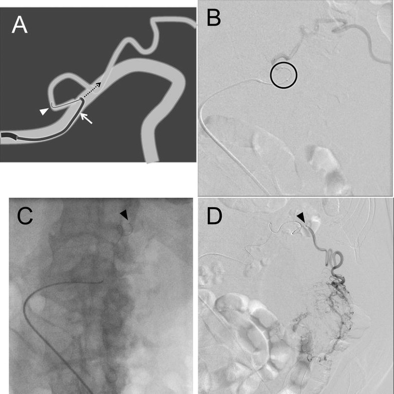 The Steerable Microcatheter: A New Device for Selective Catheterisation ...