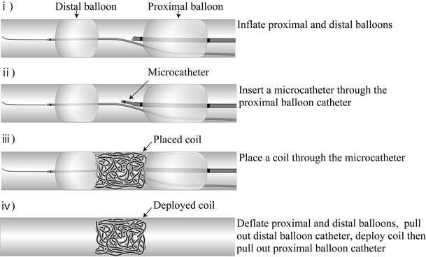 Short-Segment Coil Embolization Using a Double-Balloon Technique in an ...