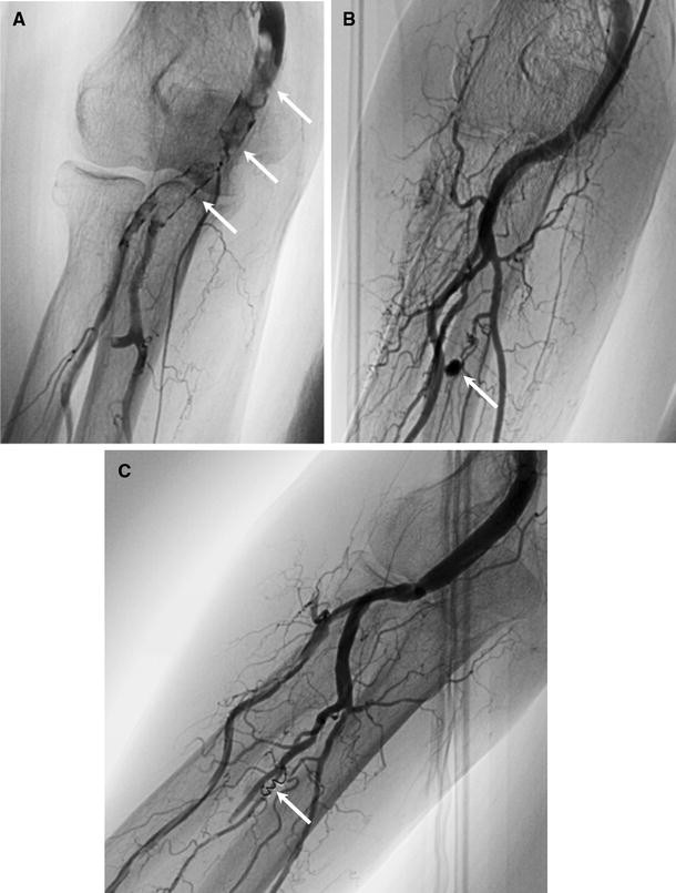 Endovascular Treatment Strategy Using Catheter-Directed Thrombolysis ...