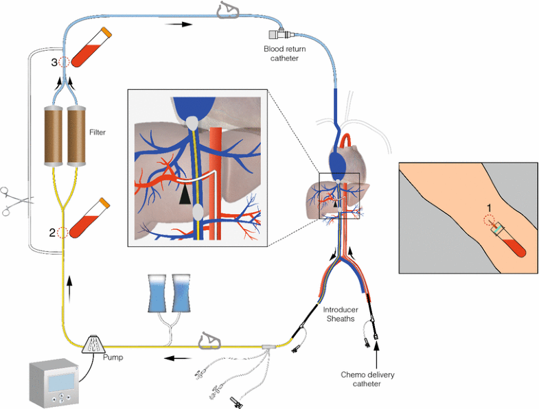 Prospective Clinical and Pharmacological Evaluation of the Delcath System’s Second-Generation ...