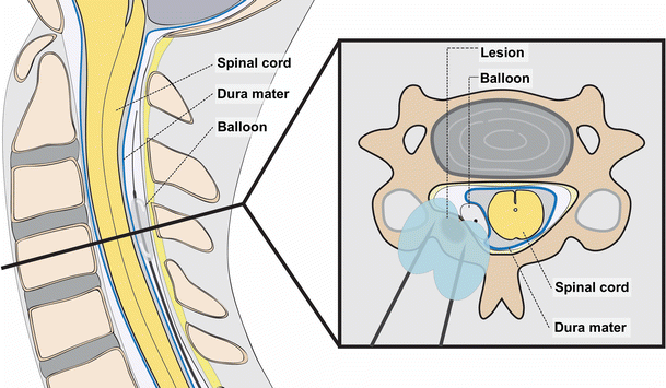 Epidural Balloon Placement for Protection of the Spinal Canal During ...