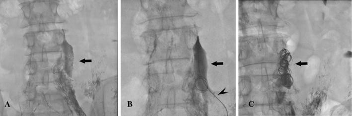 Lymphangiography and Lymphatic Embolization for the Treatment of ...