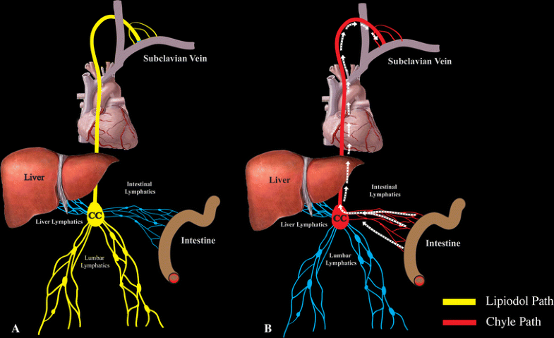 Lymphangiography and Lymphatic Embolization for the Treatment of ...