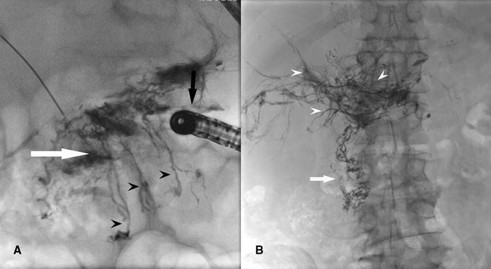 Modern Techniques of Lymphangiography and Interventions: Current Status ...