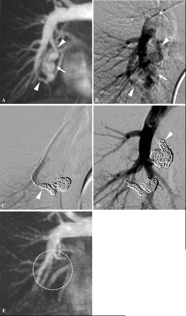 Usefulness of Hydrogel-Coated Coils in Embolization of Pulmonary ...