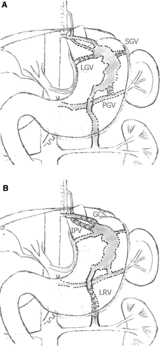 Modified Balloon-Occluded Retrograde Transvenous Obliteration (BRTO ...