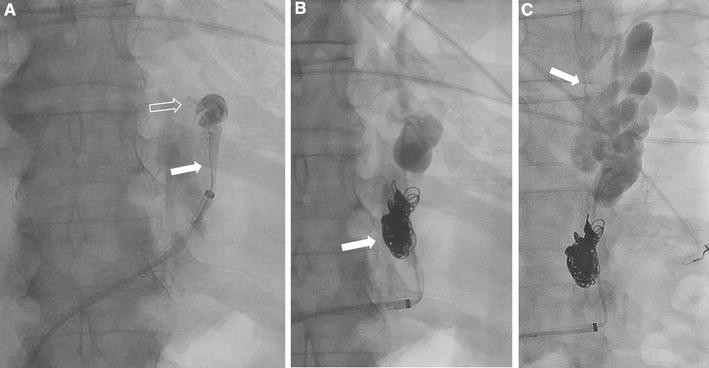 Modified Balloon-Occluded Retrograde Transvenous Obliteration (BRTO ...
