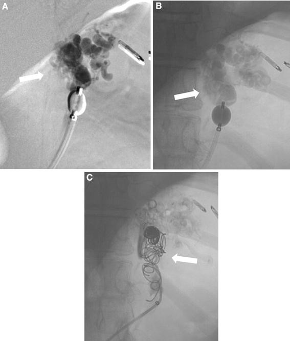 Modified Balloon-Occluded Retrograde Transvenous Obliteration (BRTO ...
