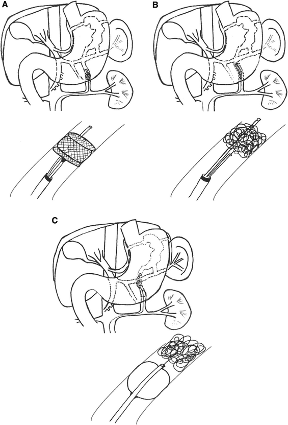 Modified Balloon-Occluded Retrograde Transvenous Obliteration (BRTO ...