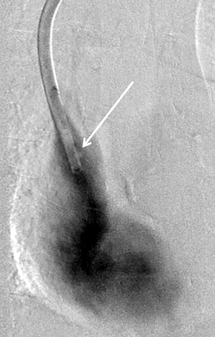 TuLIP (Tunnelled Line Intraluminal Plasty): An Alternative Technique ...