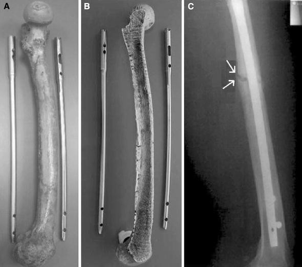 The comparison of femoral curves and curves of contemporary ...