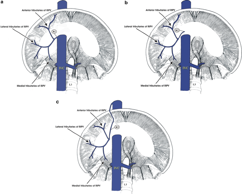 An anatomical classification of the variations of the inferior phrenic ...