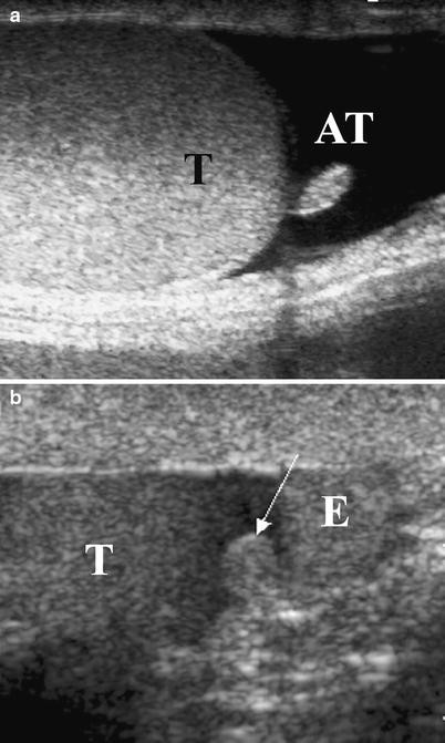 Cystic appendix epididymis: a sonomorphologic study | SpringerLink