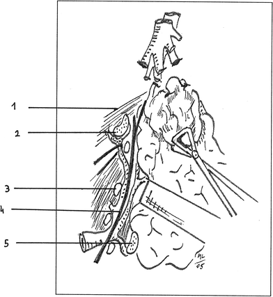 Superior approach to the inferior laryngeal nerve in thyroid surgery ...