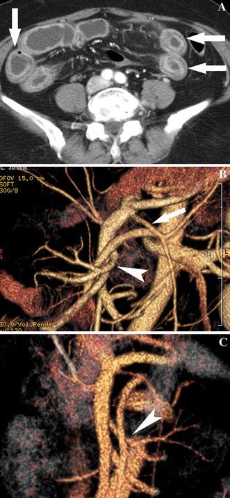 Radiologic anatomy of the superior mesenteric vein and branching ...