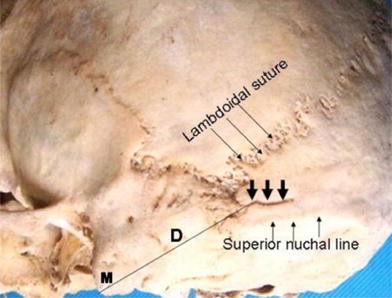 The mendosal suture of the occipital bone: occurrence in Indian ...