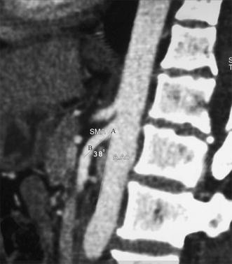 Measurement of the distance and angle between the aorta and superior ...
