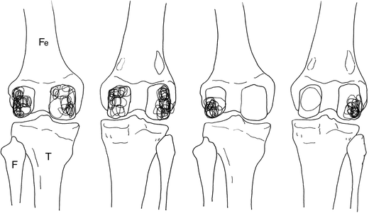 Anatomical study of the fabella, fabellar complex and its clinical ...