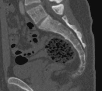 Intercoccygeal angle and type of coccyx in asymptomatic patients ...