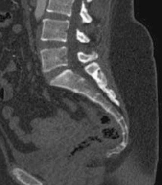 Intercoccygeal angle and type of coccyx in asymptomatic patients ...