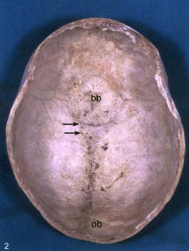 An unusually-wide human bregmatic Wormian bone: anatomy, tomographic ...