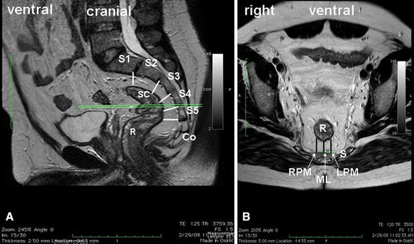 Surgical anatomy of the presacral area | SpringerLink