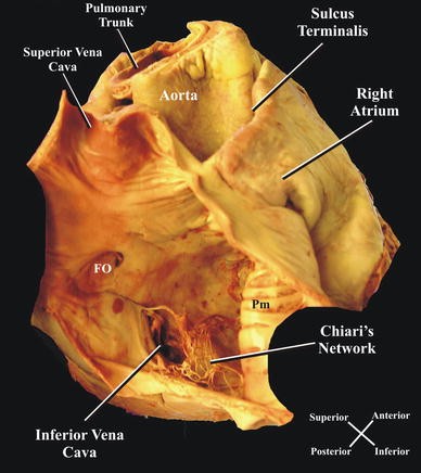 Chiari’s network: review of the literature | SpringerLink