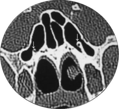 The neglected anatomical and clinical aspects of pterygoid canal: CT ...