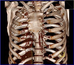 Chondro-manubrial deformity and bifid rib, rare variations seen in ...