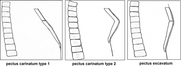 Chondro-manubrial deformity and bifid rib, rare variations seen in ...