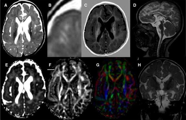 Demonstration of different histological layers of the pachygyria/agyria ...