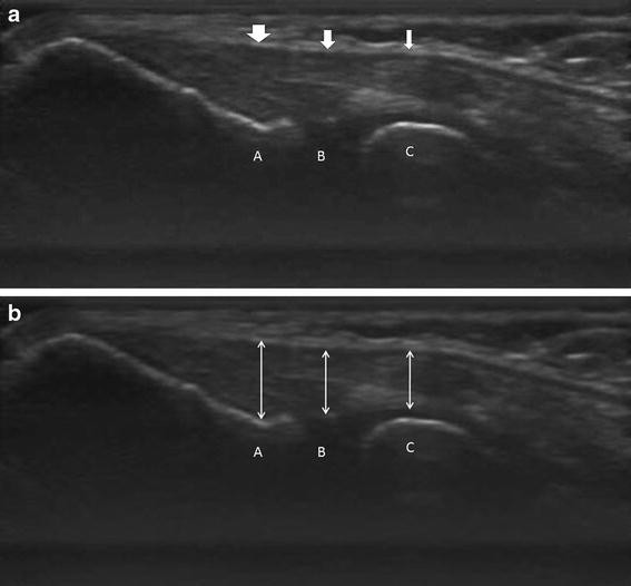 Sonographic examination of the common extensor tendon of the forearm at ...