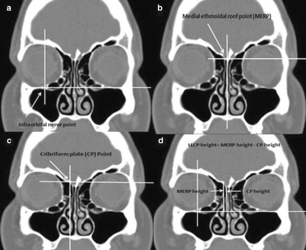 Asymmetry of lateral lamella of the cribriform plate: a software-based ...