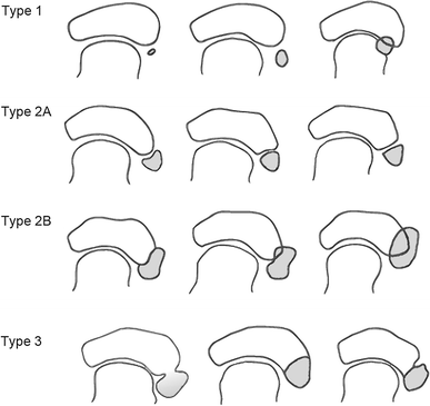 Accessory navicular bone incidence in Chinese patients: a retrospective ...